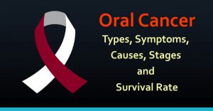 Oral Cancer- Types, Symptoms, Causes, Stages, Preventions & Treatments