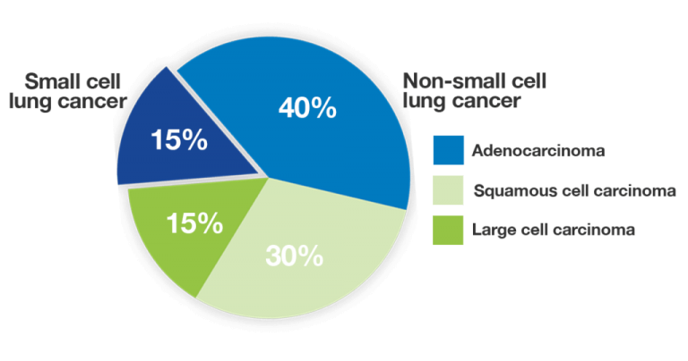 Non-Small Cell Lung Cancer - Types, Symptoms, Causes, Diagnosis